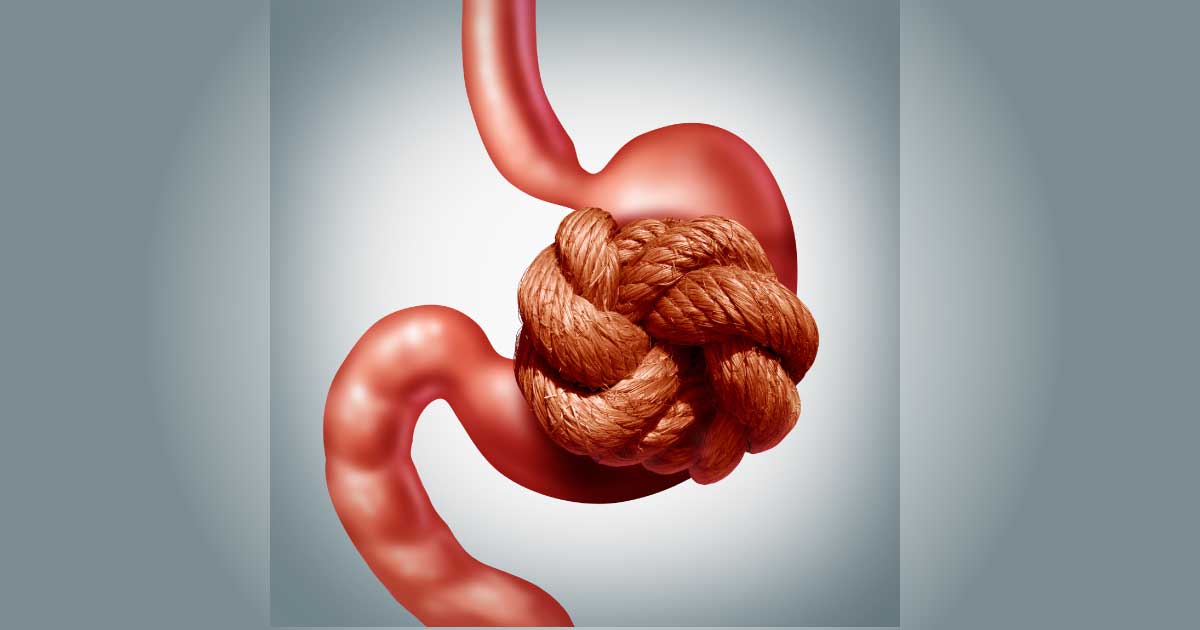 Las 5 principales causas del estreñimiento - La Carolina Medical IPS